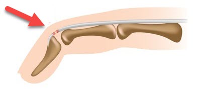 Malletfinger - Slingeland Ziekenhuis